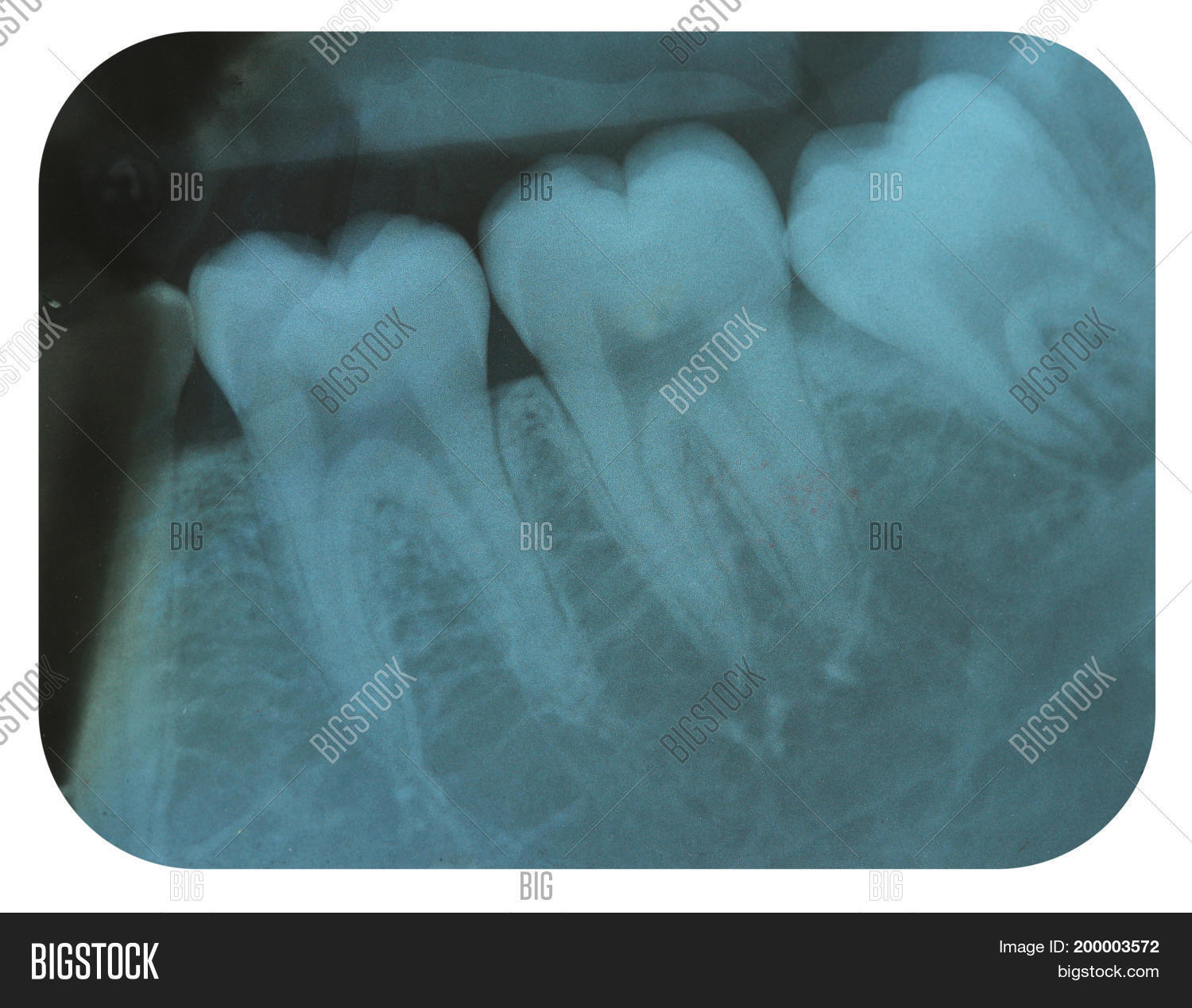 X-Ray Negative Molar Image & Photo (Free Trial) | Bigstock