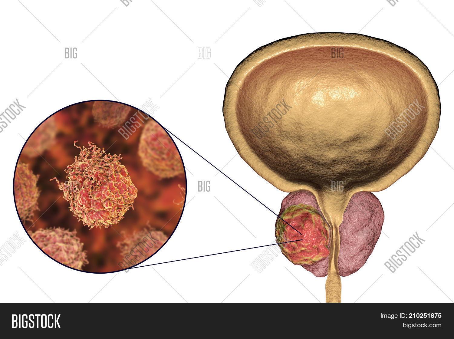 Prostate Cancer, 3D Image & Photo (Free Trial) | Bigstock