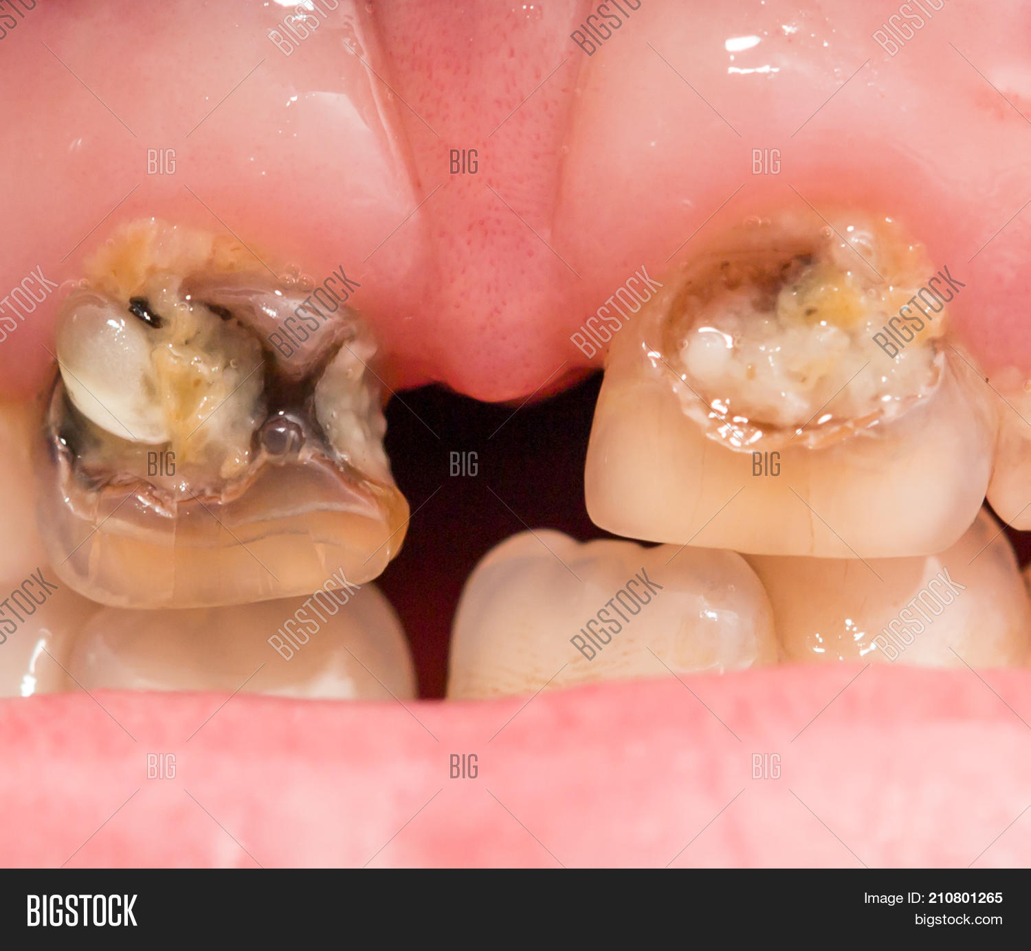 Rotten Teeth. Macro Image & Photo (Free Trial) | Bigstock