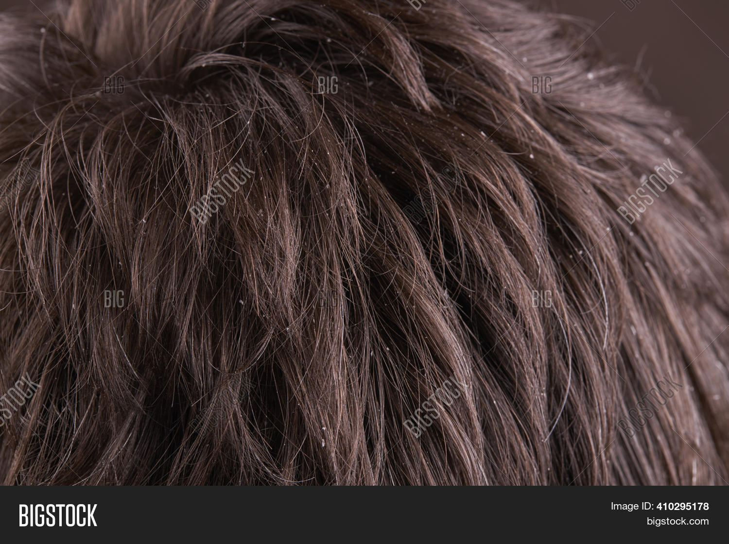Male Person Dandruff Image & Photo (Free Trial) | Bigstock