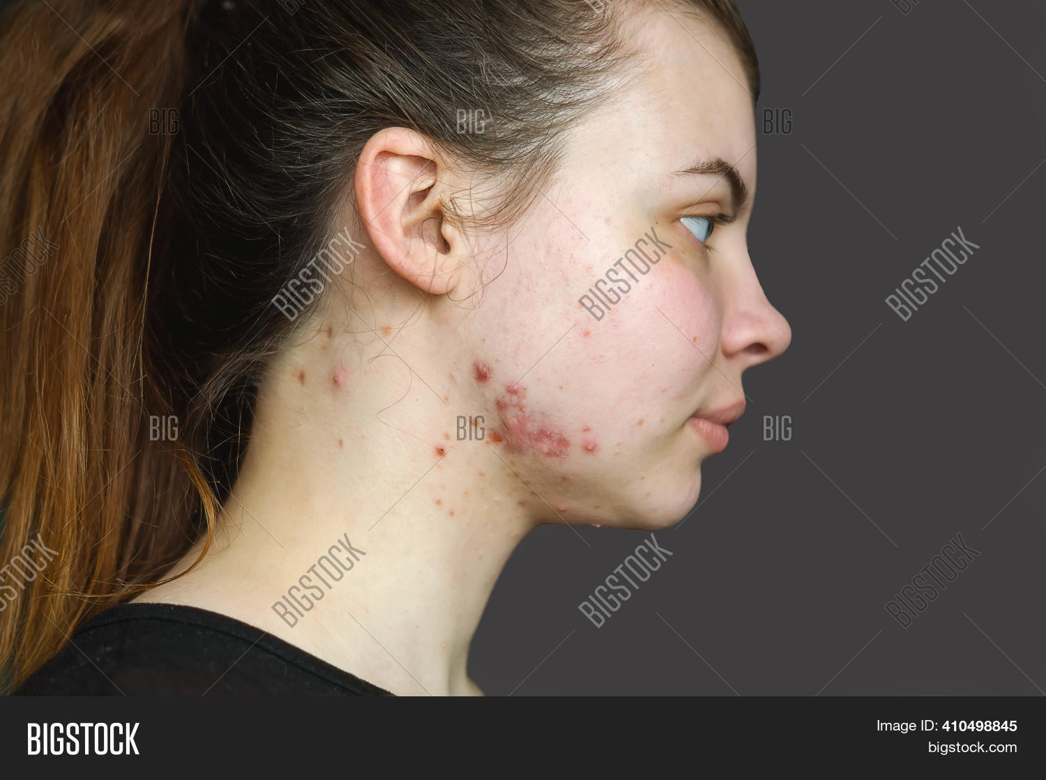 Red Pimples On Skin Image & Photo (Free Trial) | Bigstock