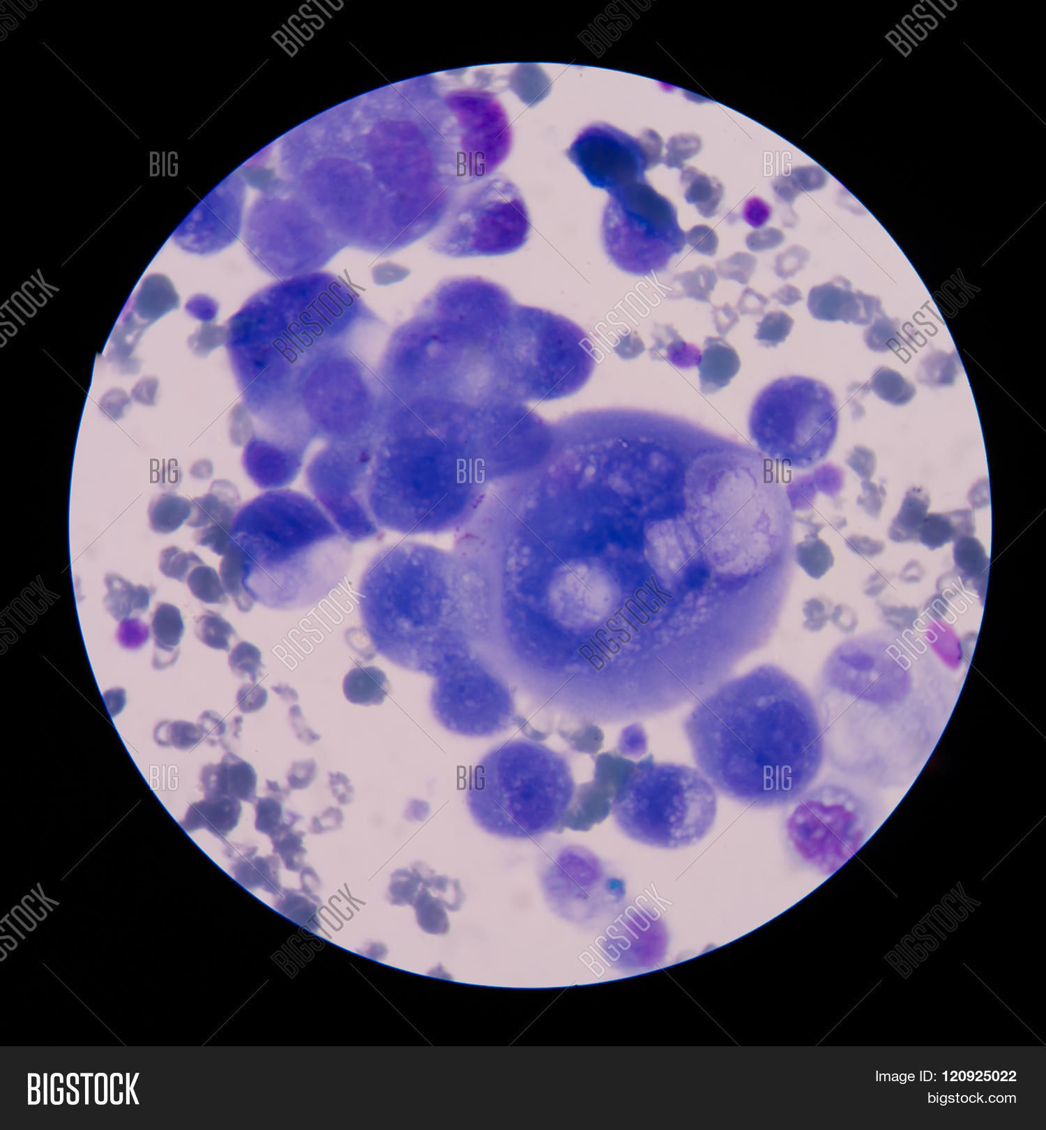 Malignant Cells Image & Photo (Free Trial) | Bigstock