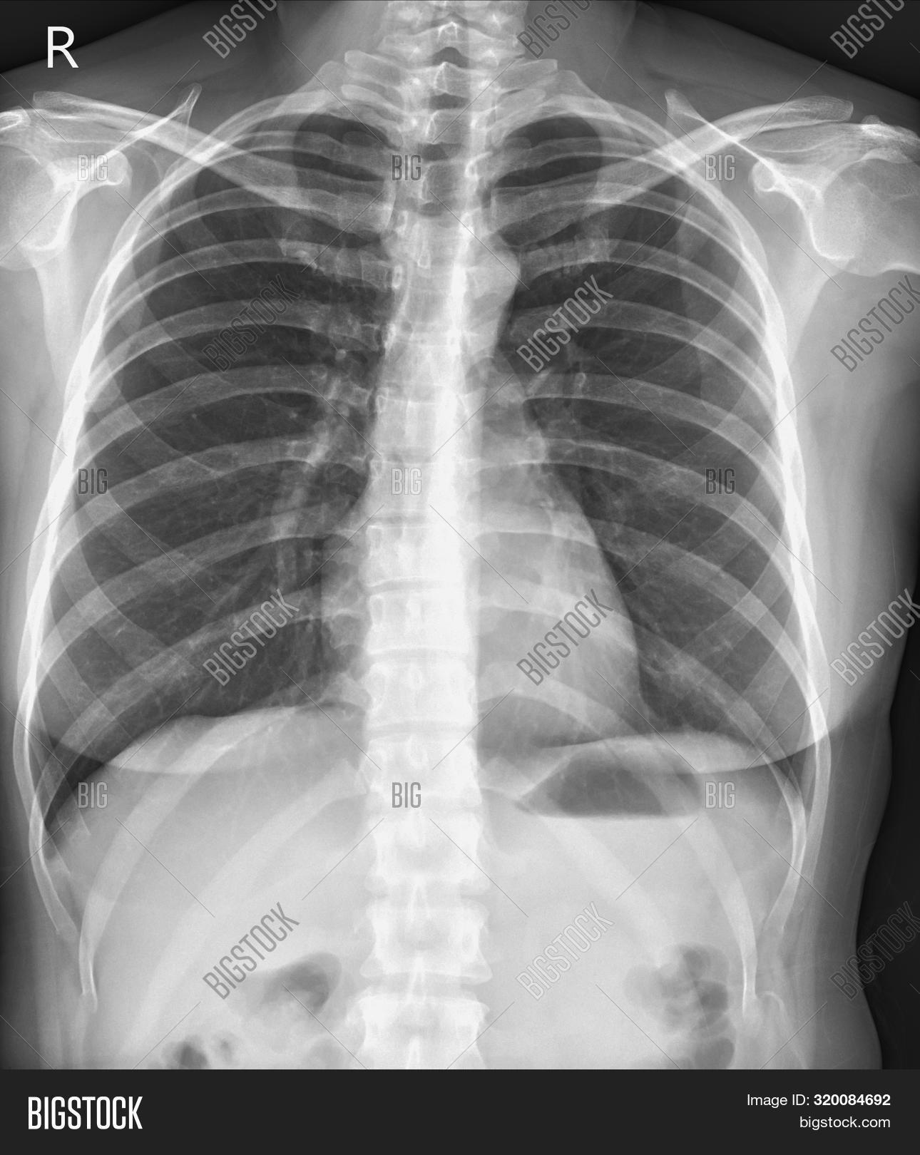 Chest X-ray Female 37 Image & Photo (Free Trial) | Bigstock