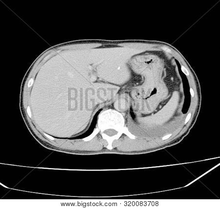 Pacemaker X-ray Image Image & Photo (Free Trial) | Bigstock