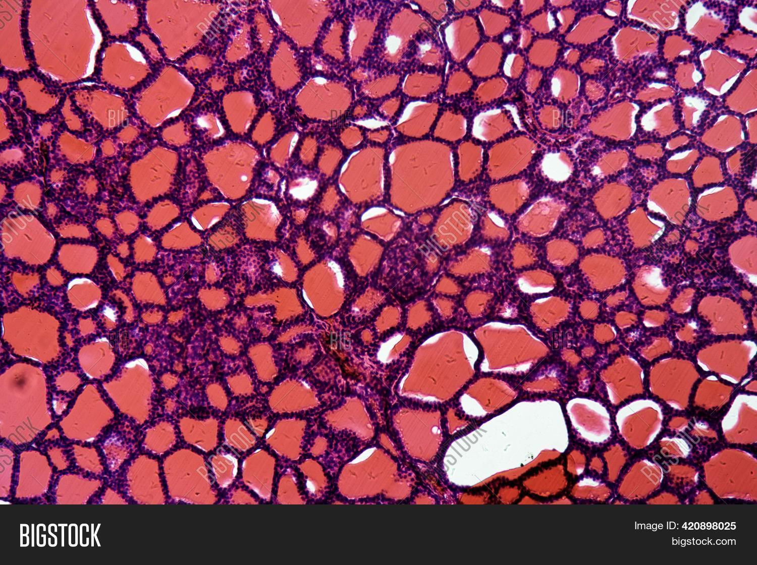 Thyroid Gland Cells Image & Photo (Free Trial) | Bigstock