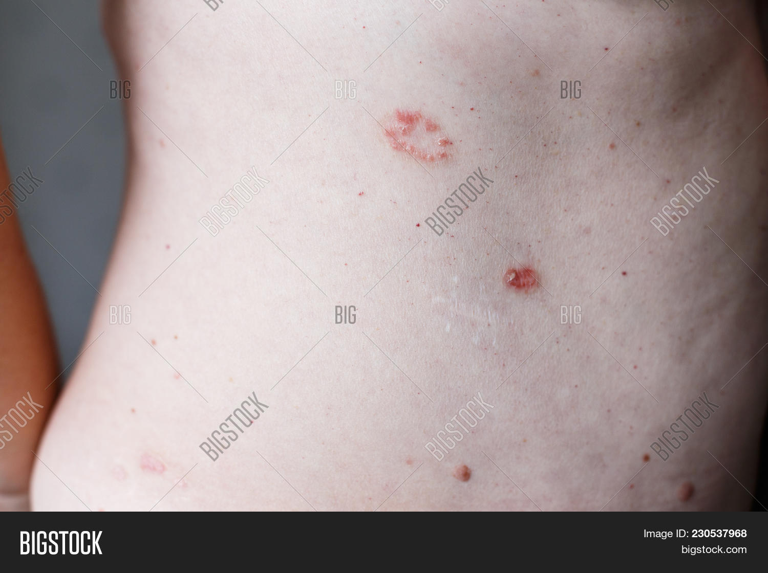 Psoriasis Skin. Image & Photo (Free Trial) | Bigstock