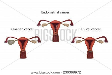 Ovarian, Endometrial Vector & Photo (Free Trial) | Bigstock