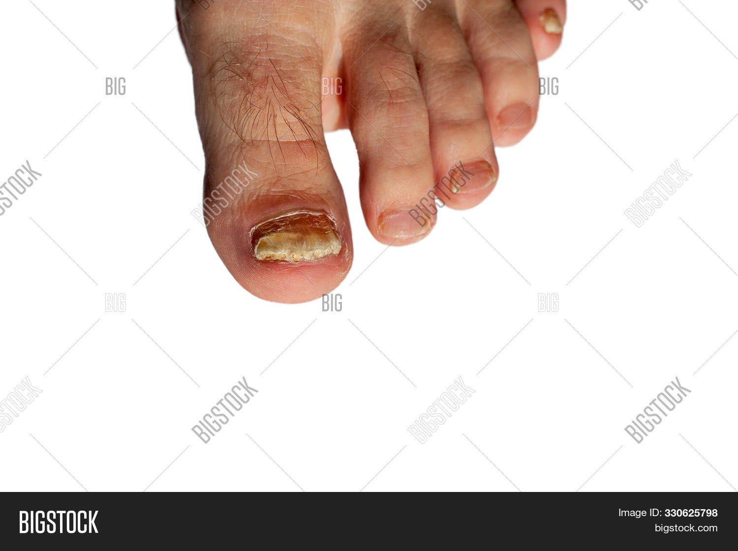 Fungus On Toenails. Image & Photo (Free Trial) | Bigstock