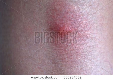 Insect Bite On Human Image & Photo (Free Trial) | Bigstock