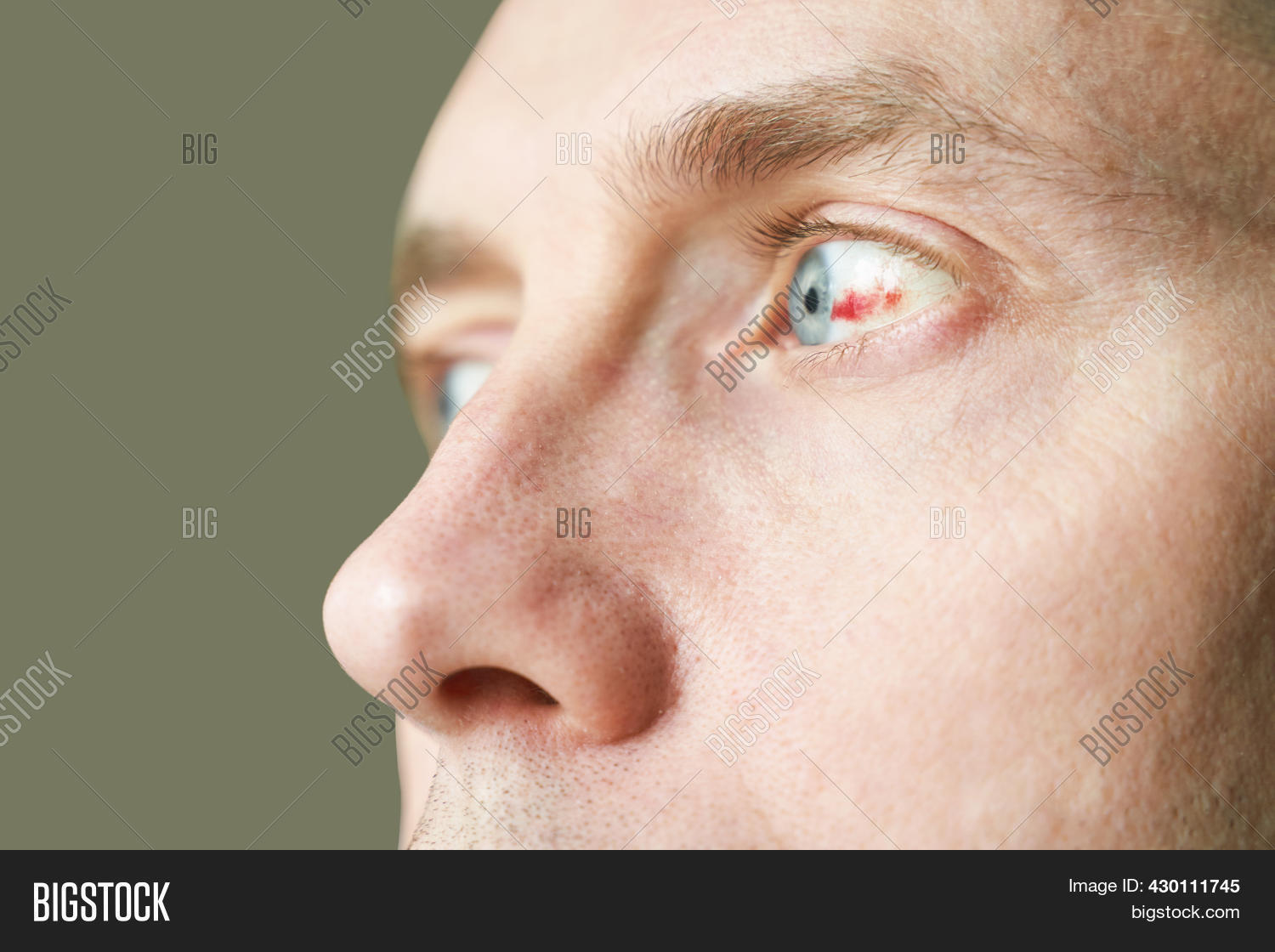 Man Damaged Eye Ball. Image & Photo (Free Trial) | Bigstock