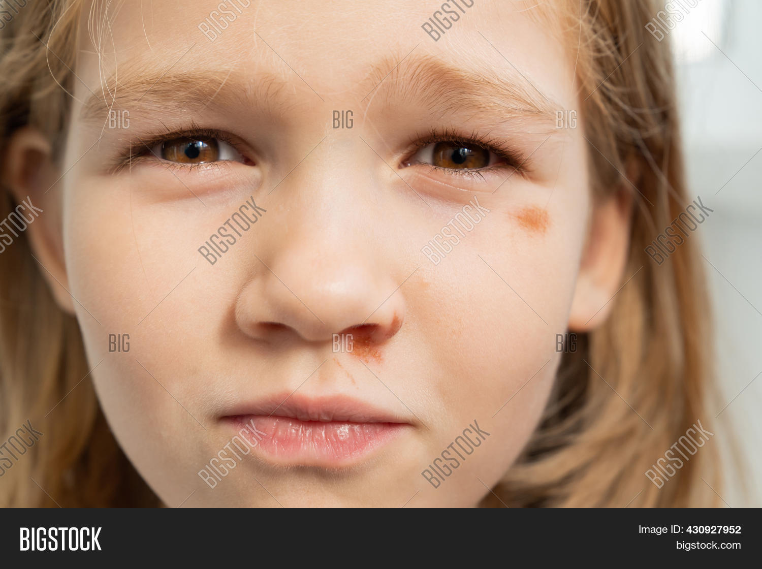 Portrait Girl Abrasion Image & Photo (Free Trial) | Bigstock