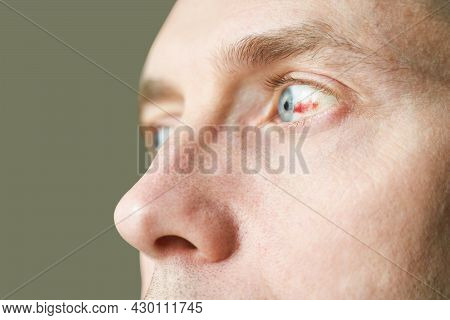 Man Damaged Eye Ball. Image & Photo (Free Trial) | Bigstock