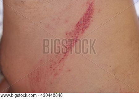 Scratch Lesion Caused Image & Photo (Free Trial) | Bigstock