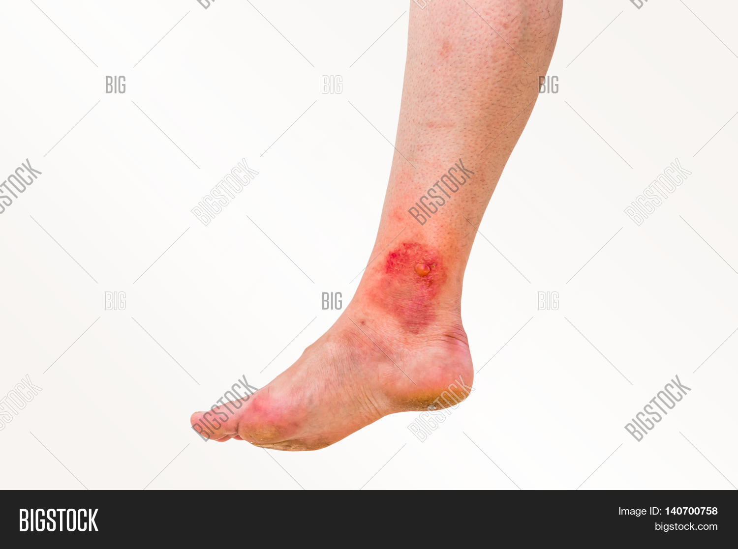 Red Rash On Leg Image & Photo (Free Trial) | Bigstock