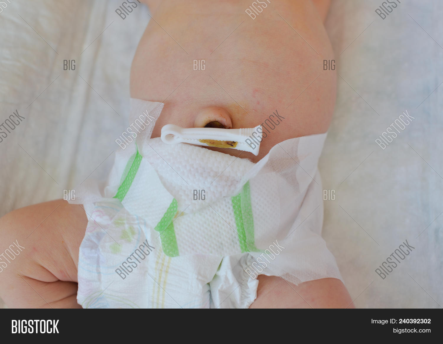 Umbilical Cord Clamp Image & Photo (Free Trial) | Bigstock