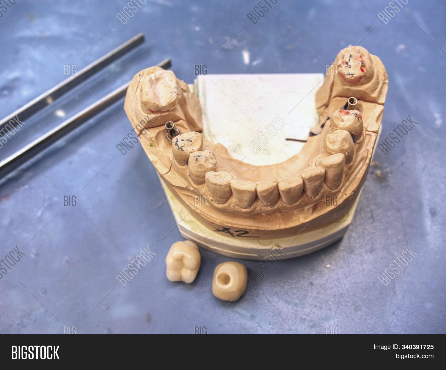Metal Cast Pin Tooth Image & Photo (Free Trial) | Bigstock