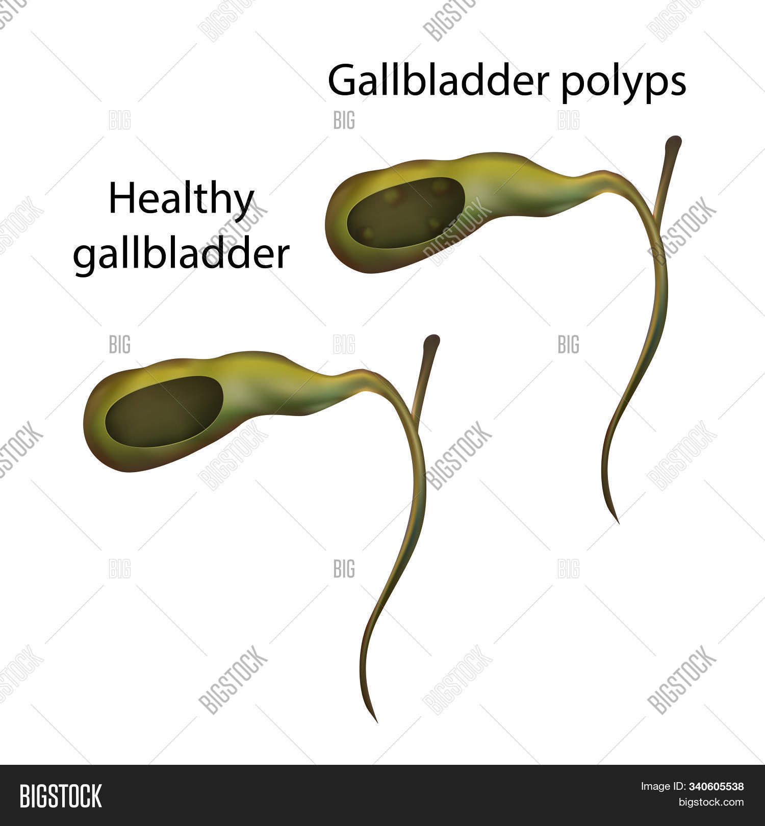 Gallbladder Polyps Image & Photo (Free Trial) | Bigstock