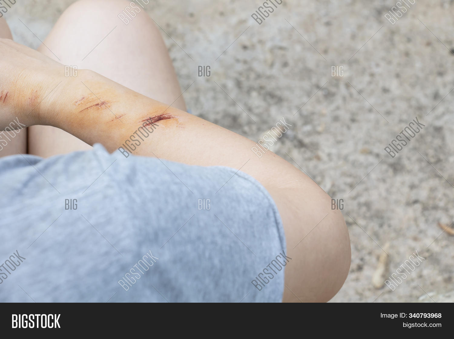 Wound Form Scabs On Image & Photo (Free Trial) | Bigstock