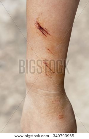 Wound Form Scabs On Image & Photo (Free Trial) | Bigstock