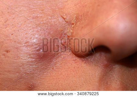 Inflamed Skin On Face Image & Photo (Free Trial) | Bigstock