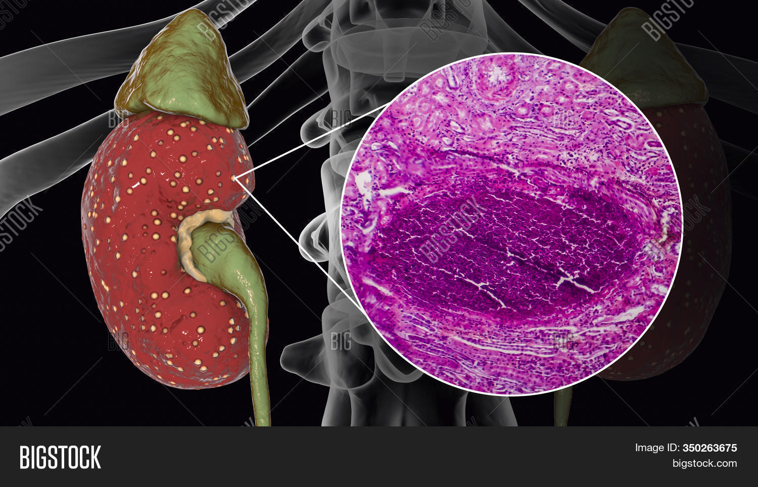 Acute Pyelonephritis, Image & Photo (Free Trial) | Bigstock