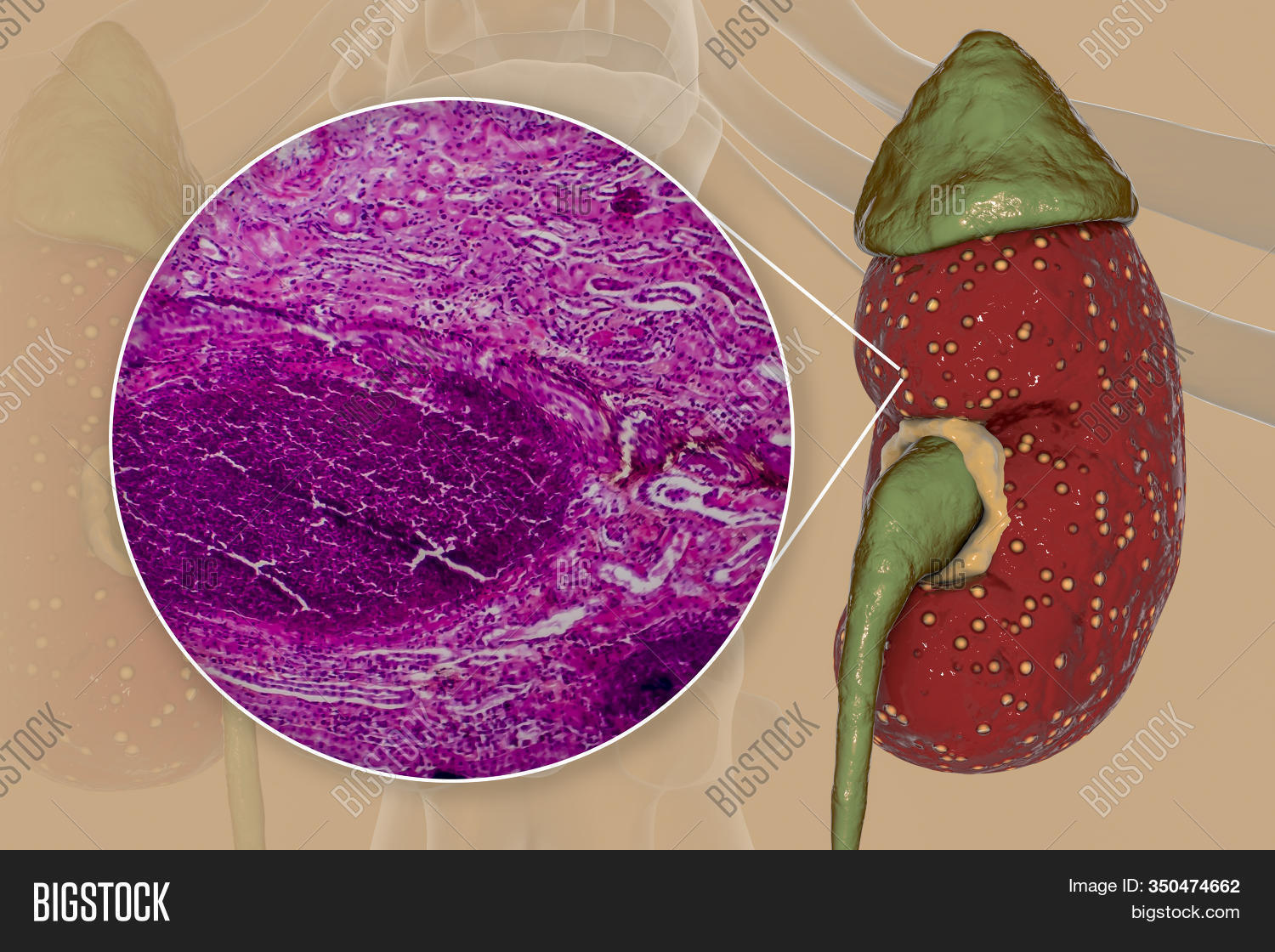 Acute Pyelonephritis, Image & Photo (Free Trial) | Bigstock