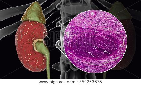 Acute Pyelonephritis, Image & Photo (Free Trial) | Bigstock