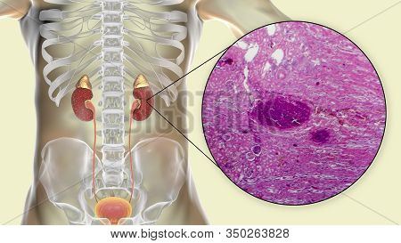 Acute Pyelonephritis, Image & Photo (Free Trial) | Bigstock