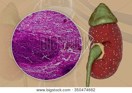 Acute Pyelonephritis, Image & Photo (Free Trial) | Bigstock