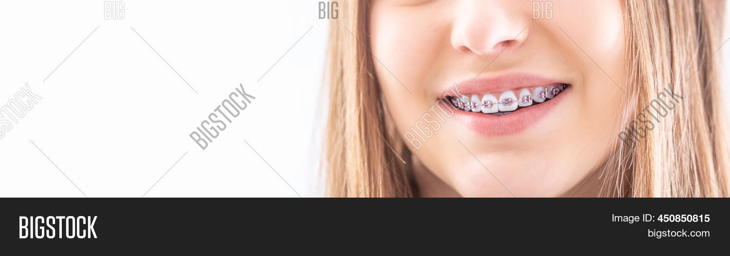 Dental Brace On Image And Photo Free Trial Bigstock