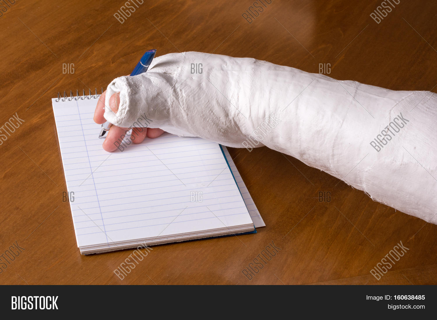 Person Arm Cast Image & Photo (Free Trial) | Bigstock