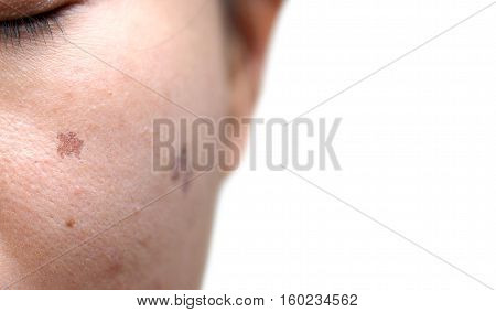 Wound Scar On Female Image & Photo (Free Trial) | Bigstock