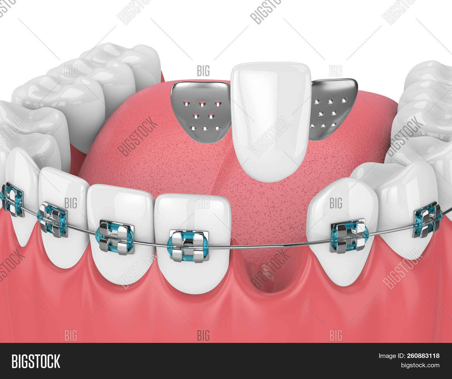 3d Render Teeth Image & Photo (Free Trial) | Bigstock