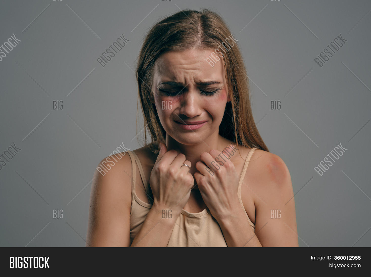 Blonde Girl Bruises On Image & Photo (Free Trial) | Bigstock
