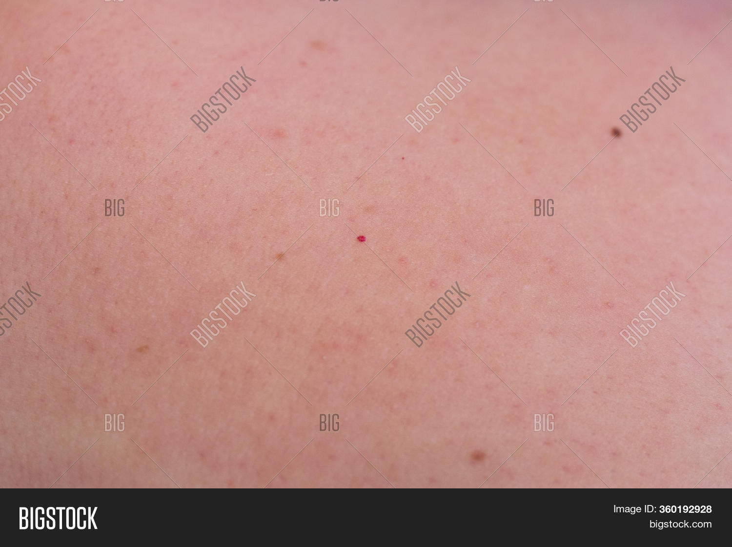 Woman Birthmarks On Image & Photo (Free Trial) | Bigstock