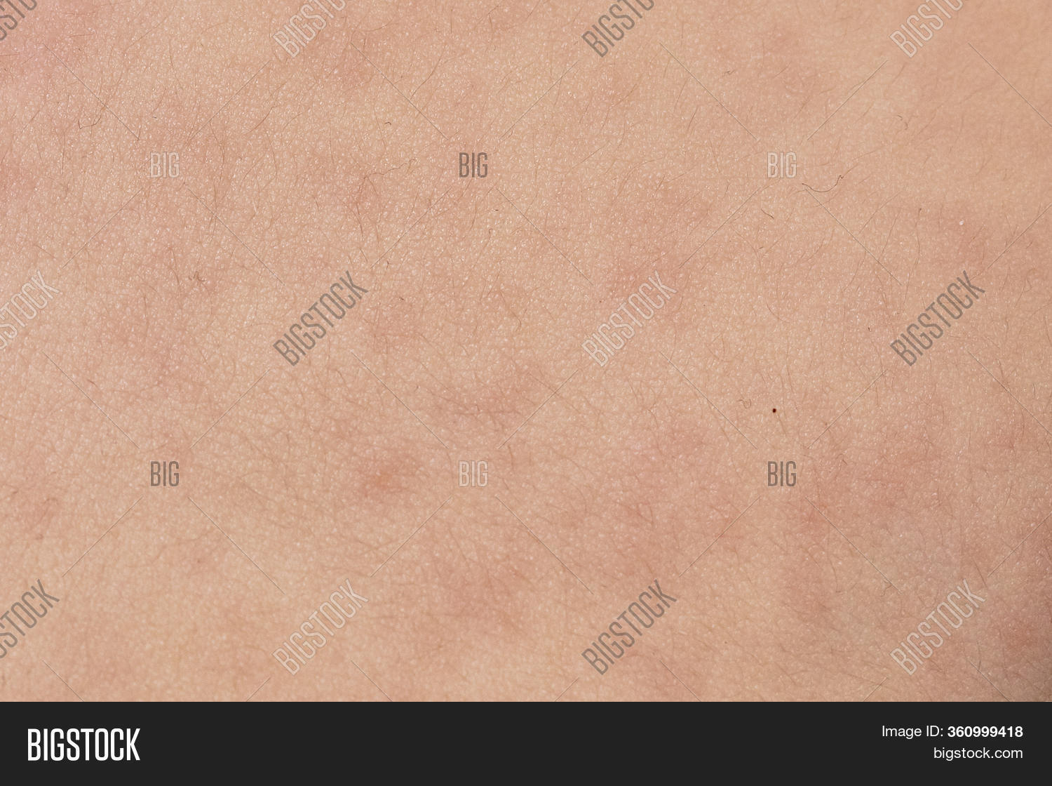 Roseola Rash Viral Image & Photo (Free Trial) | Bigstock