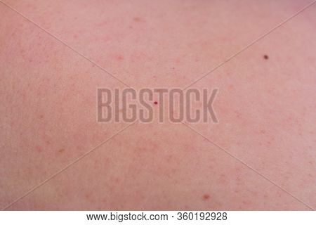 Woman Birthmarks On Image & Photo (Free Trial) | Bigstock