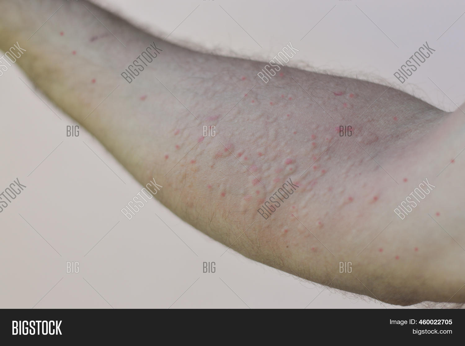 Male Hands Affected By Image & Photo (Free Trial) | Bigstock