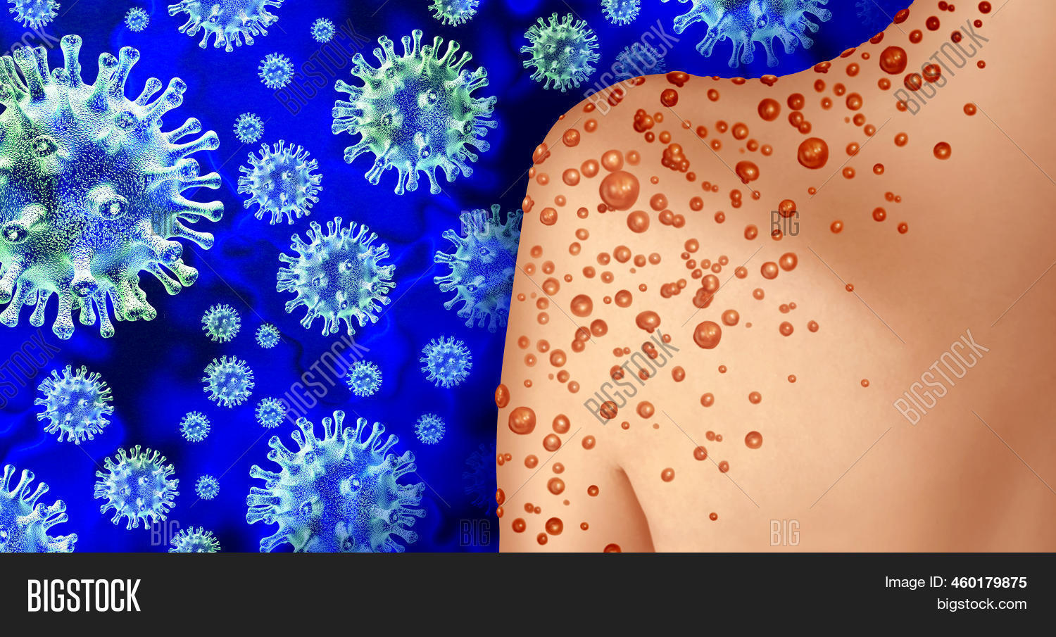 Monkey Pox Monkeypox Image & Photo (Free Trial) | Bigstock