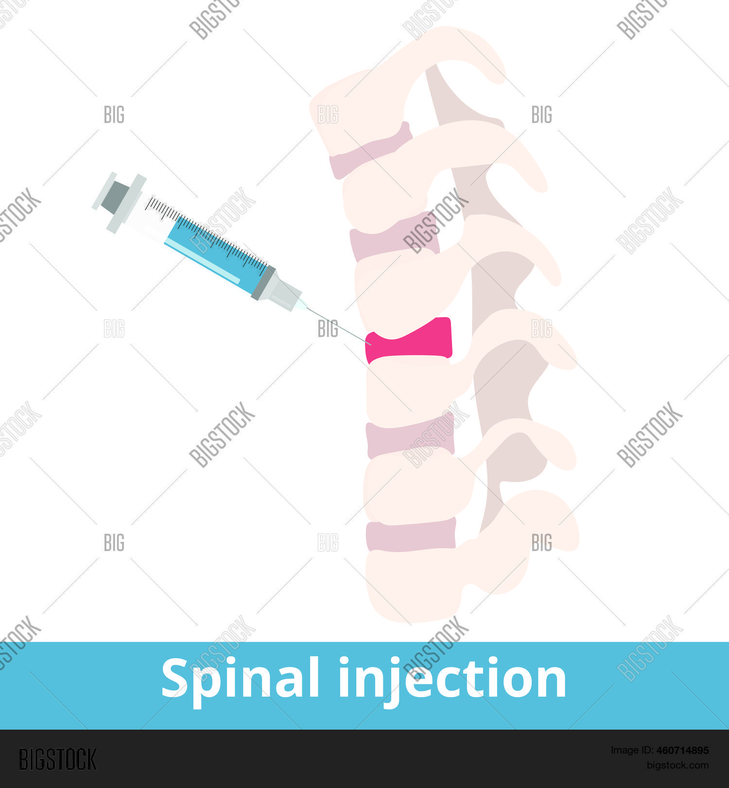 Spinal Injection. Vector & Photo (Free Trial) | Bigstock