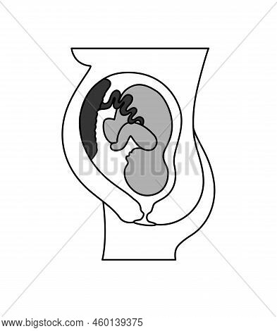 Placental Previa. Vector & Photo (Free Trial) | Bigstock