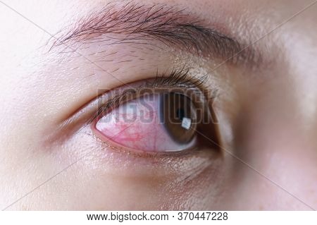 Red Bloodshot Eye Image & Photo (Free Trial) | Bigstock