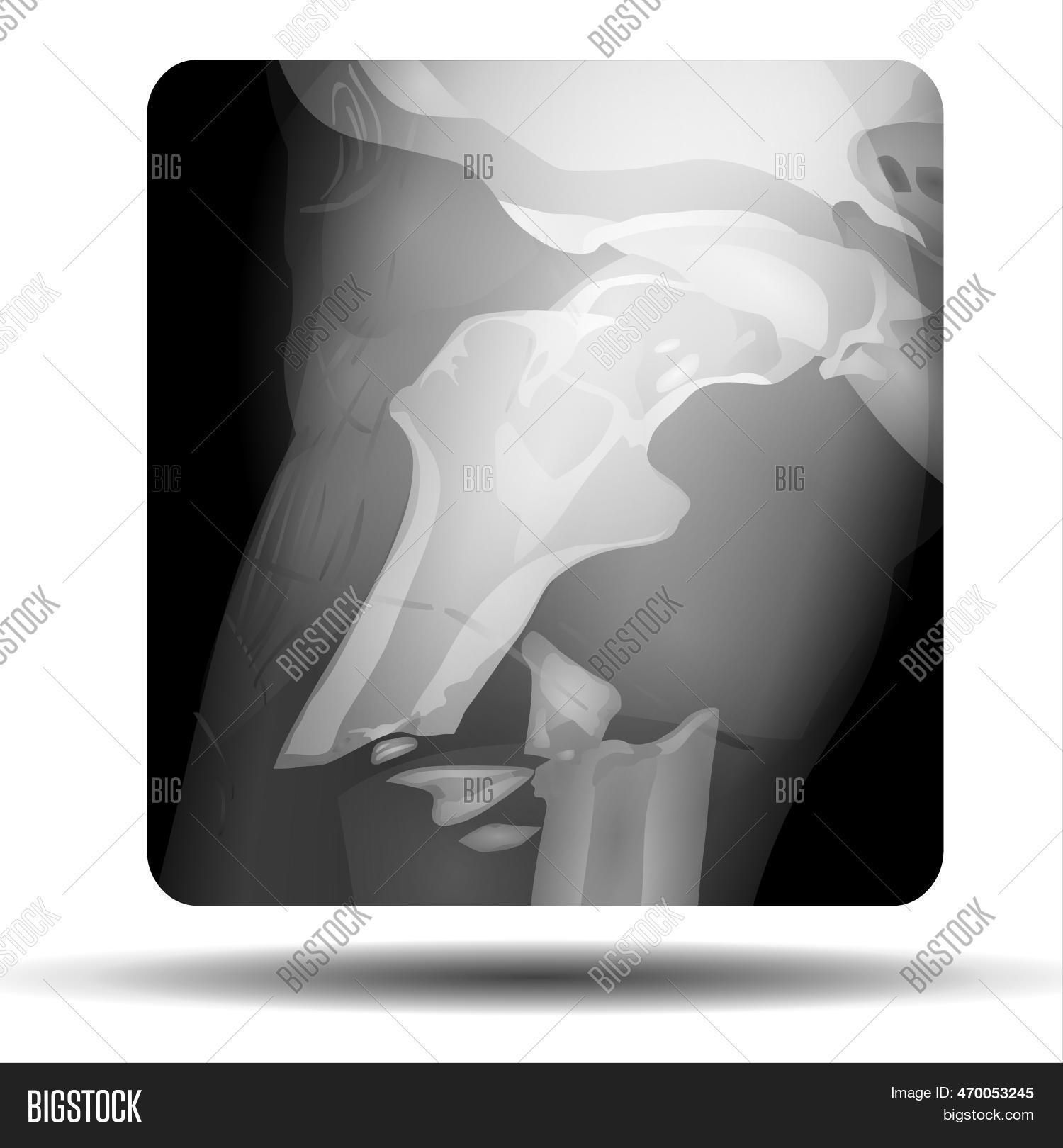 X-ray Broken Thigh Image & Photo (Free Trial) | Bigstock