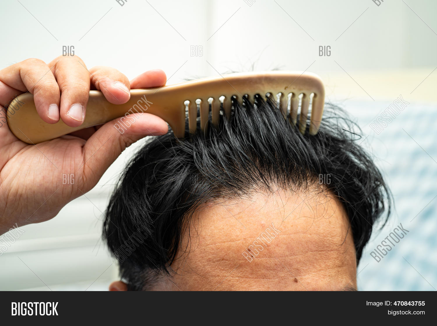 Bald Front Head Begin Image & Photo (Free Trial) | Bigstock