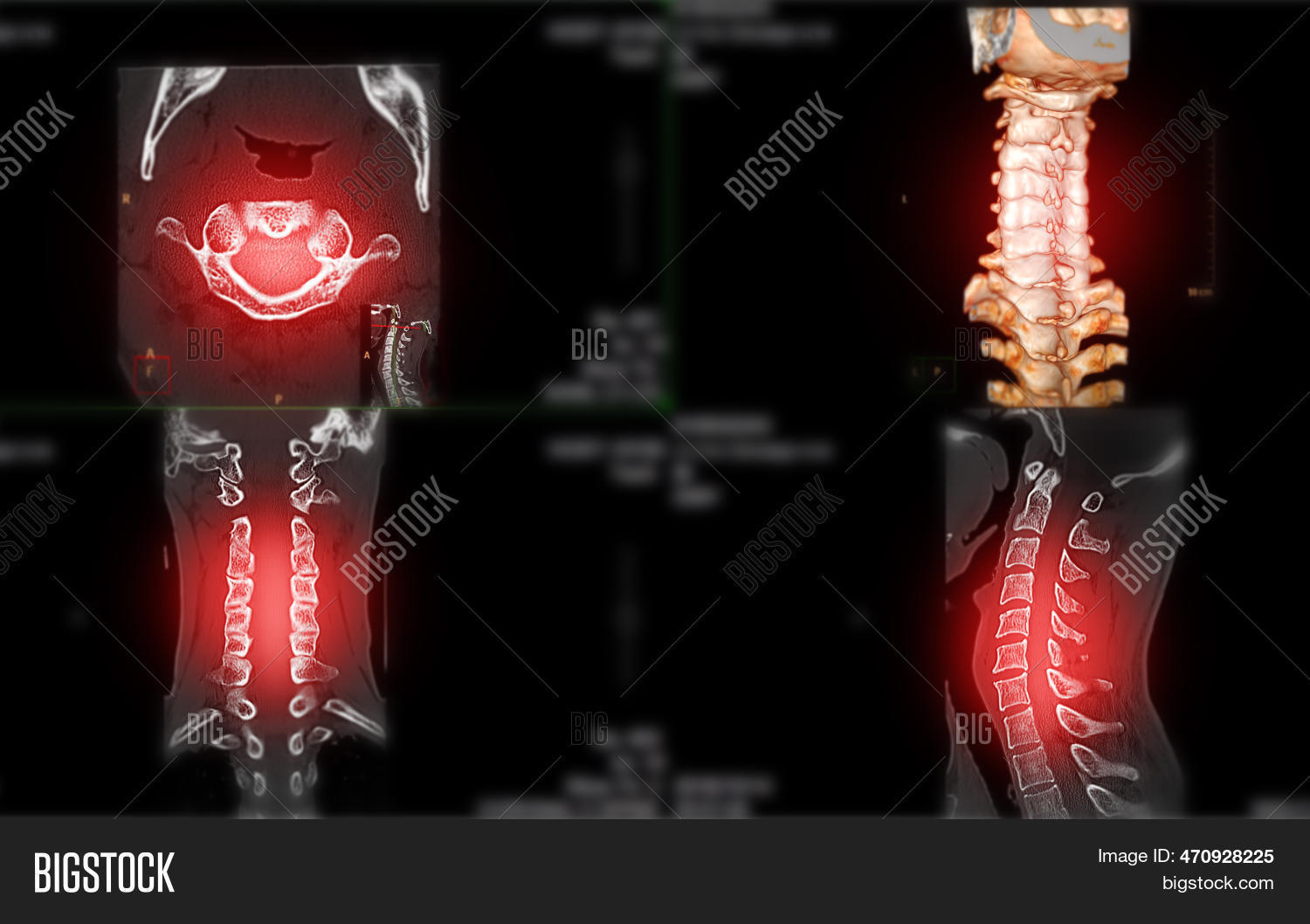 Ct Scan C-spine Image & Photo (Free Trial) | Bigstock