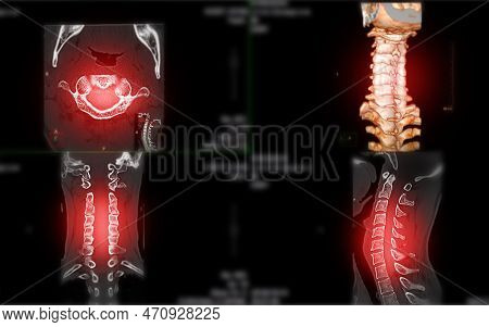 Ct Scan C-spine Image & Photo (Free Trial) | Bigstock