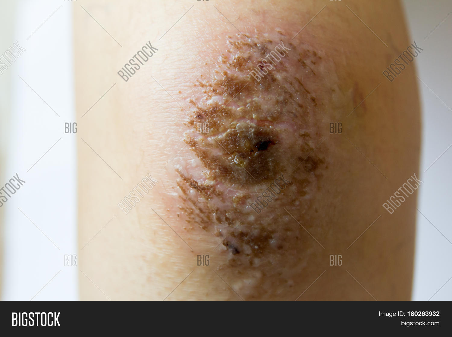 Closed Red Scab Injury Image & Photo (Free Trial) | Bigstock
