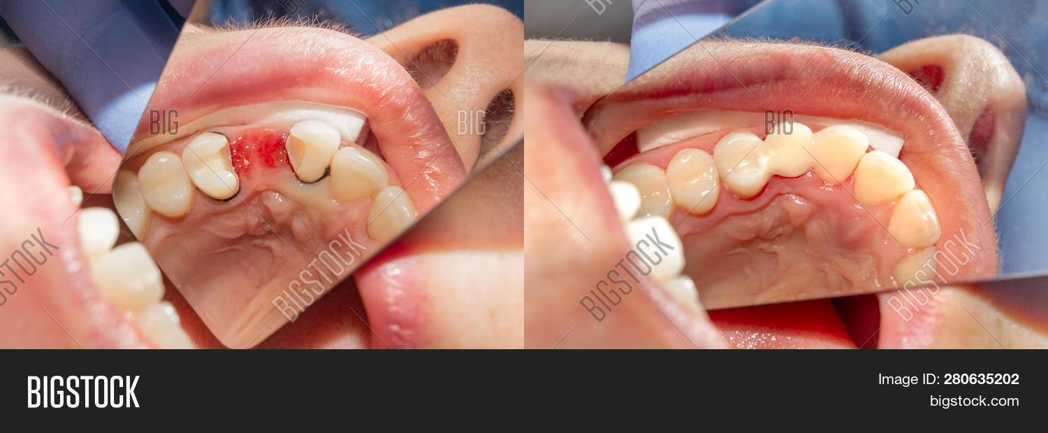 Filling Restoration Image & Photo (Free Trial) | Bigstock