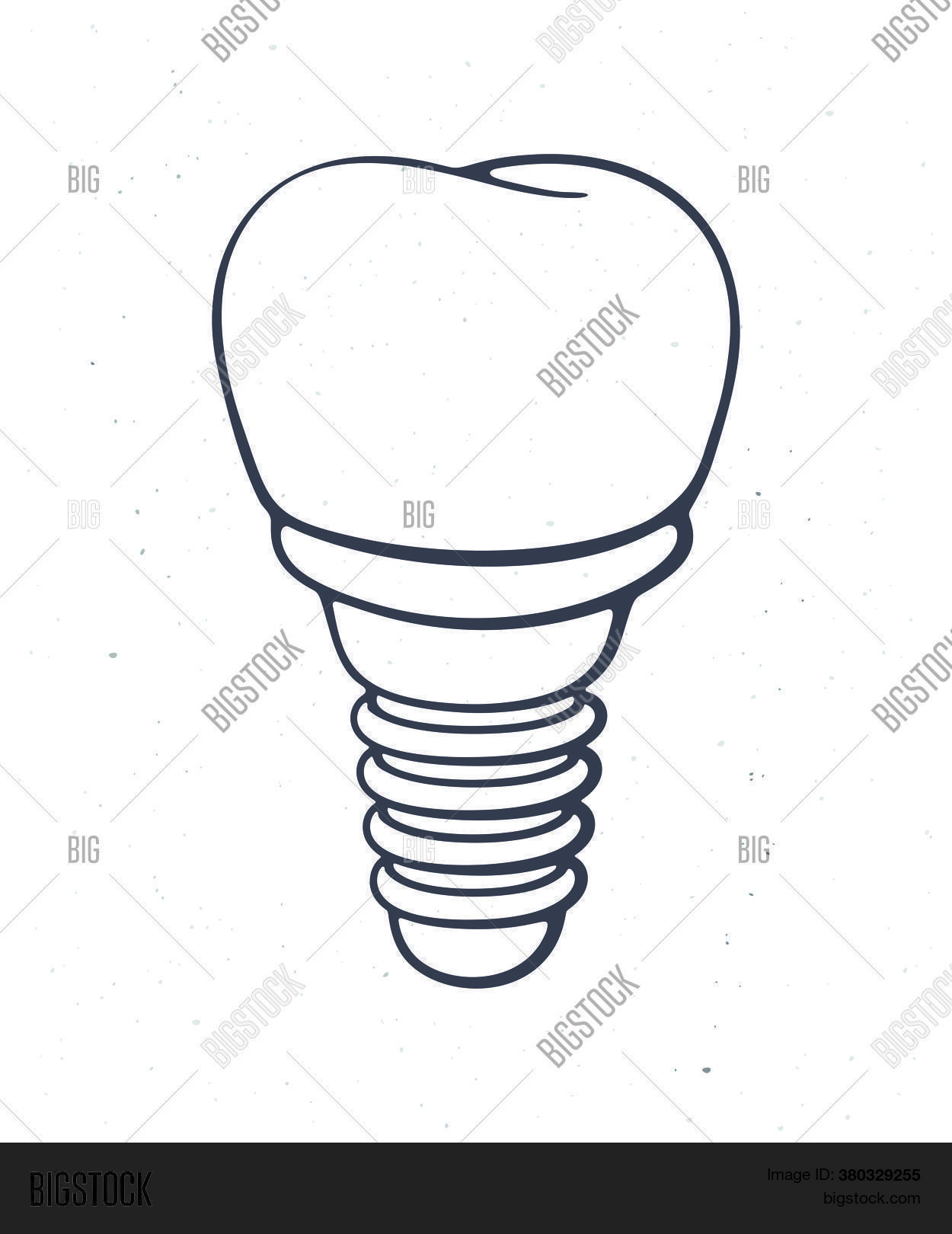 Dental Implant Human Vector & Photo (Free Trial) | Bigstock