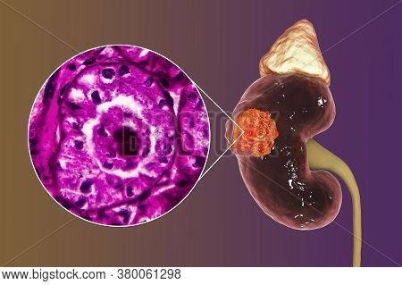 Kidney Cancer, Renal Image & Photo (Free Trial) | Bigstock
